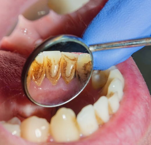 House of Dontics | Orthodontist in Ahmedabad | InvisAlign